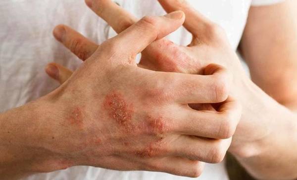 Qué hacer si tengo manos secas: cómo combatir la resequedad y consejos ...